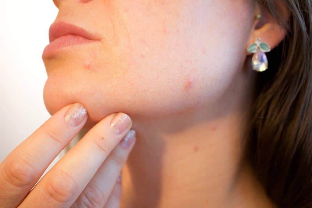 Bug Bite Identification - The 10 Most Common Bug Bites and How To ...