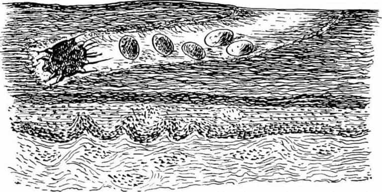 Tiny White Bugs On Skin - What You Should Know About Scabies Mites ...
